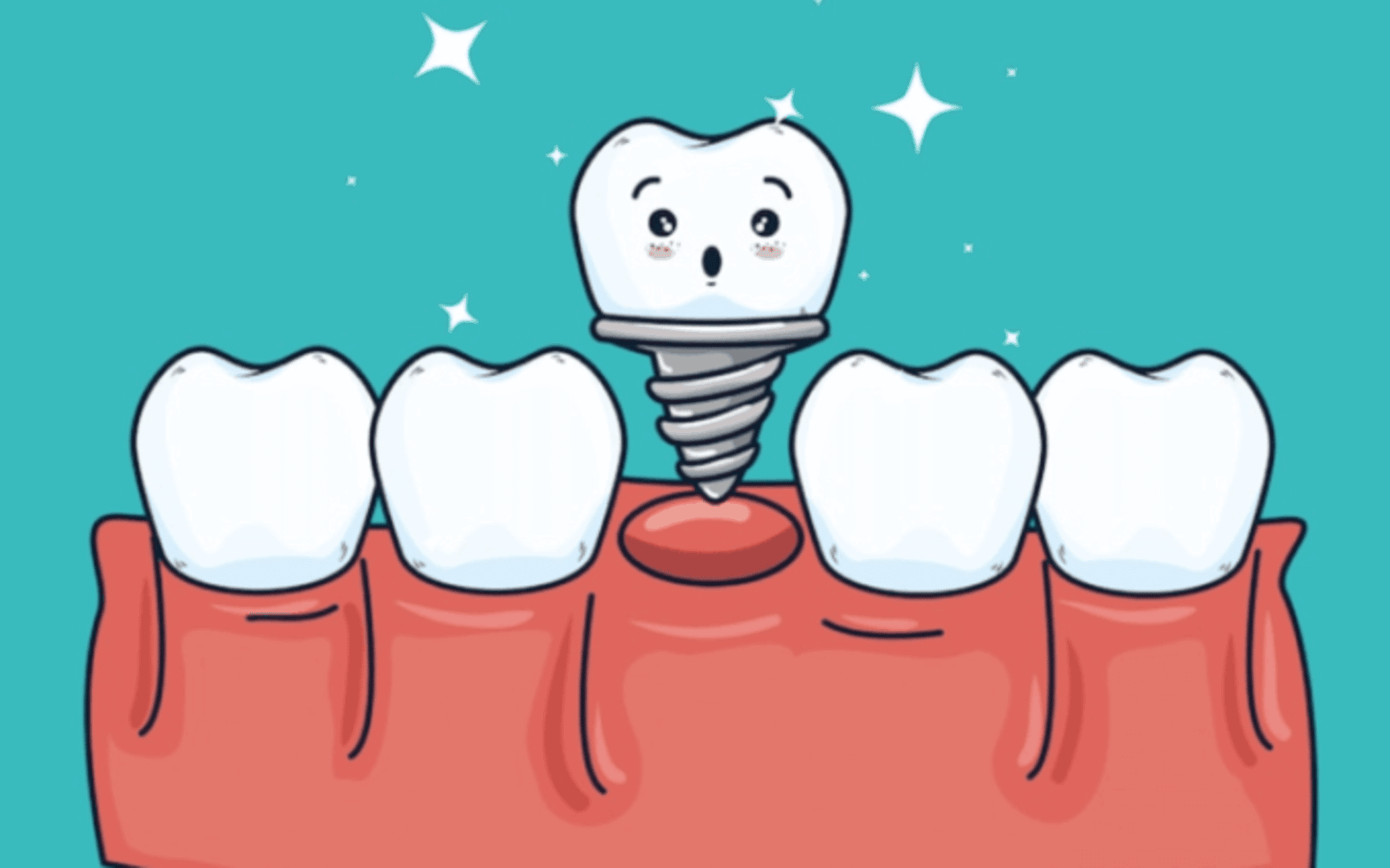 Affordable Dental Implants: Hollywood Smile - Sharksmind